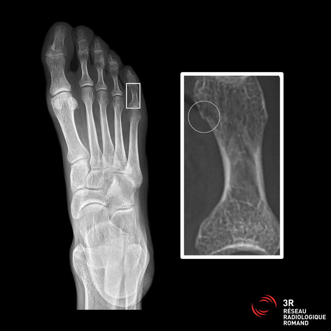 Radiographie - Aide à la détection des fractures avec l'IA chez 3R