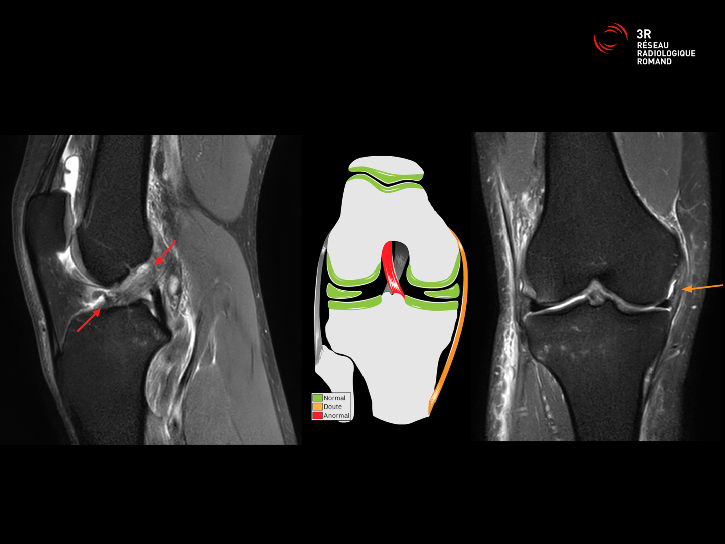 IRM du genou - Aide à la détection des lésions du genou avec l'IA chez 3R
