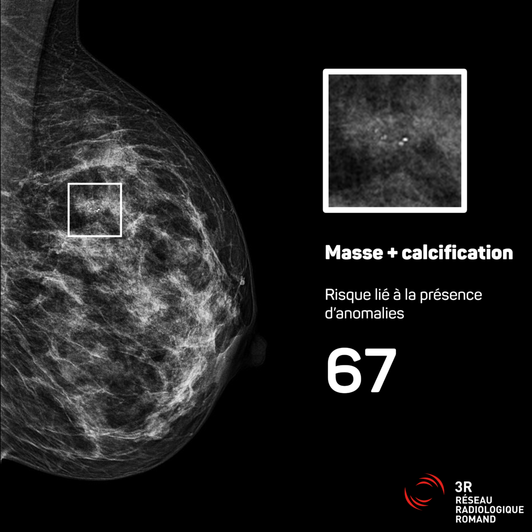 Mammographie - Aide au diagnostic du cancer du sein avec l'IA chez 3R