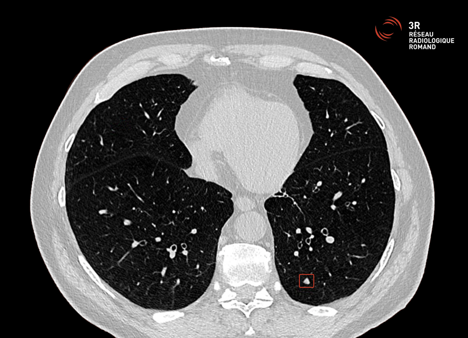 Scanner - Aide au diagnostic du cancer du poumon avec l'IA chez 3R